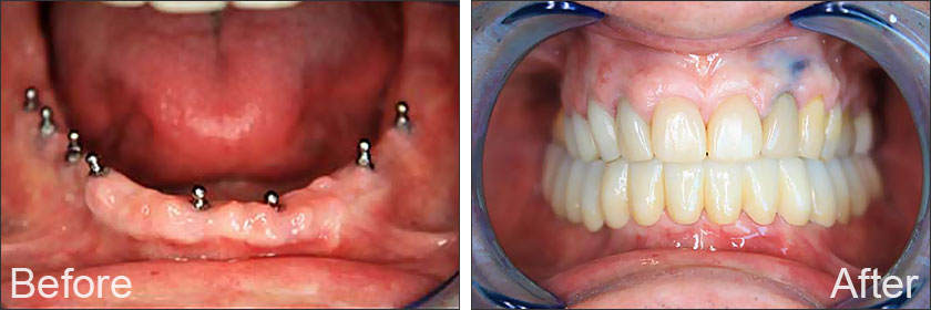Gallery - Mini Implant Supported Porcelain Roundhouse - Barnhart Dental